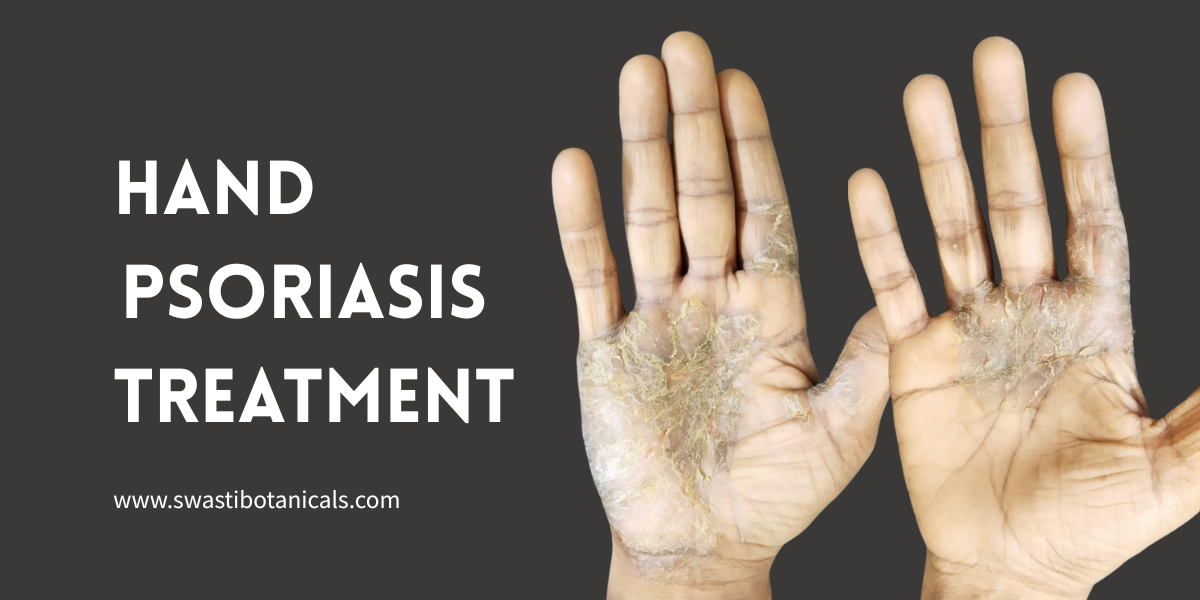 Hand Psoriasis Treatment: Complete Evidence-Based Guide – Swasti Botanicals